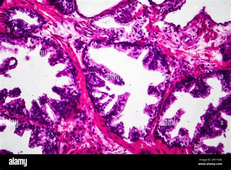 Benign Prostatic Hyperplasia Light Micrograph Photo Under Microscope Showing Dilated Glands
