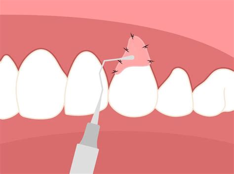 Injerto De Encía Tena Dental