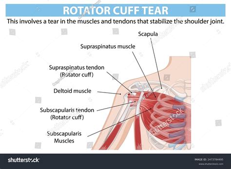 Detailed Anatomy Shoulder Rotator Cuff Tear Stock Vector Royalty Free