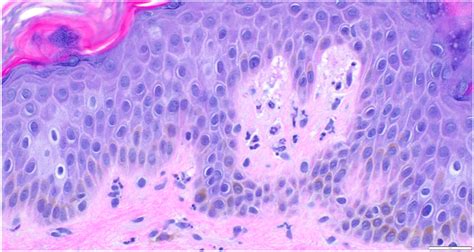 Urticarial Dermatitis Herpetiformis A Rare Presentation Of An Uncommon
