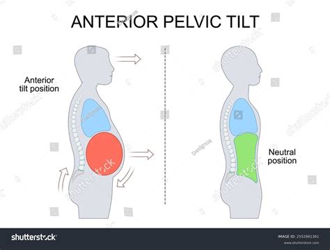 Anterior Pelvic Tilt Pelvic Rotation Lumbar Stock Vector Royalty Free 2552861361 Shutterstock