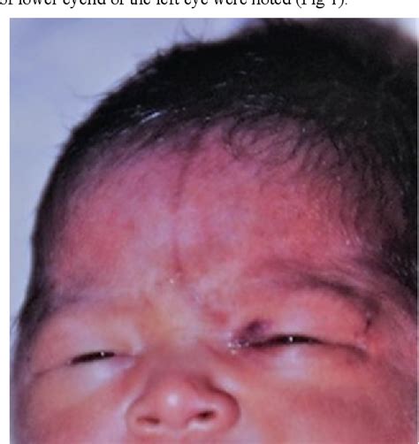 Figure 1 From Ocular Birth Injuries Following Forceps Assisted Delivery