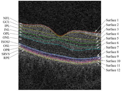 Deep Learning Techniques For Retinal Layer Segmentation To Aid Ocular