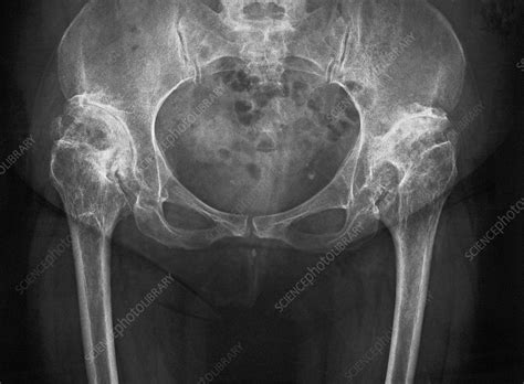 Congenital Hip Dysplasia X Ray Stock Image M1400439 Science