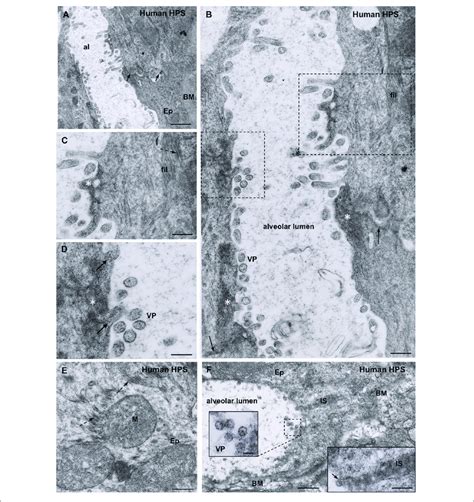 Transmission Electron Microscopy Of Human Lung From A Lethal Hps Download Scientific Diagram