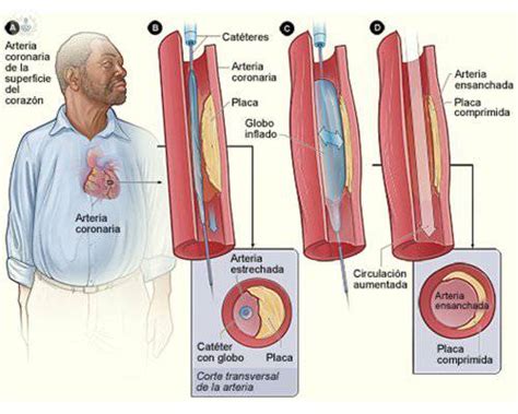 Cardiopatía Isquémica Crónica Cardiopatía Isquémica Causas Síntomas