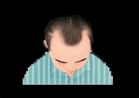 发际线m型后移，如何自救？