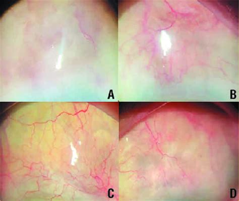 Figure Types Of Filtering Blebs Fb In The Long­term Period After