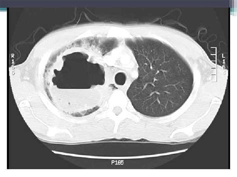 Bronchiectasis Lung Abscess Lung Abscess