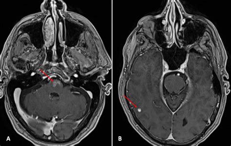 Axial Section Post Contrast T1 Weighted Images A And B Demonstrates