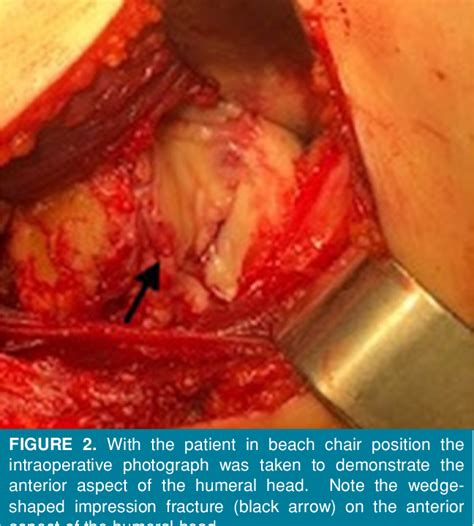 Figure 2 From Bilateral Locked Posterior Shoulder Dislocation