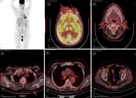 Figure 1 From Immunoglobulin G4 Related Lymph Node Disease With An