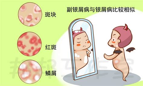 副银屑病都是怎么好的？ 知乎