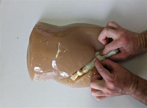 Train Yourself Pediatric Inguinal Hernia Reduction Emergency Physicians Monthly