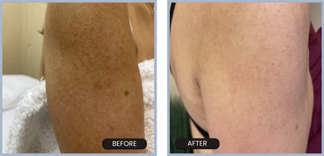 Algae Peel Is The Best Treatments For A Glowing Skin