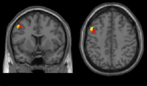 Anatomical Overlay Of The Left Middle Frontal Gyrus Area Showing Download Scientific Diagram