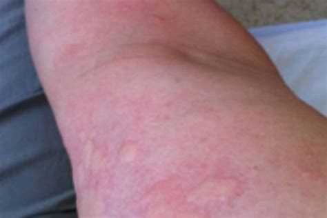 柯萨奇病毒疹风团图片