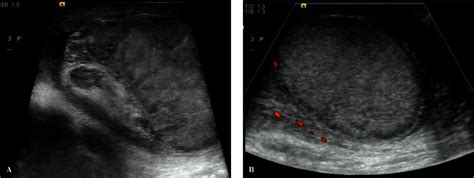 Standards For Scrotal Ultrasonography Pmc