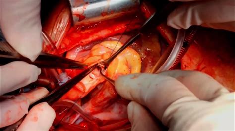 Subaortic Membrane Excision Surgery Youtube