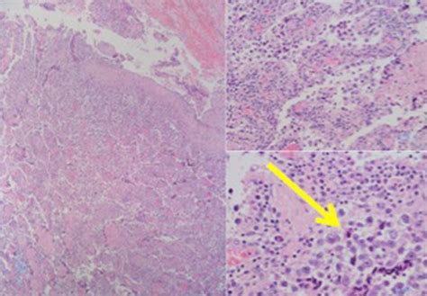 Tumor Pathology Findings Initial Surgery Recognized Two Cell