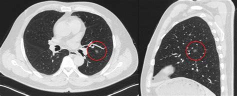 Ground Glass Opacity In The Left Lingular Segment In The Internal 13