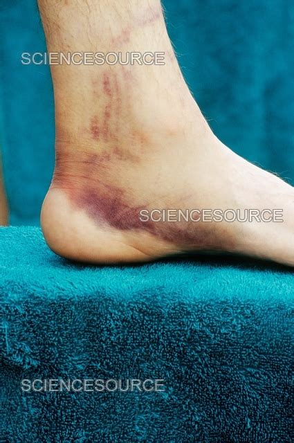 Ankle Bruises
