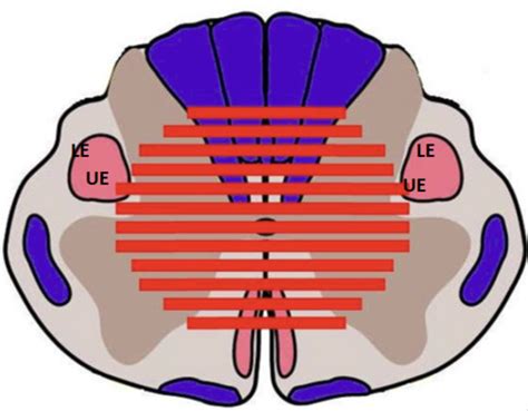 Sci Classification Asia And Incomplete Syndromes Flashcards Quizlet