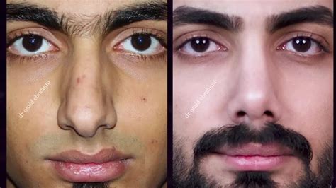 رضایت مراجعه کننده عزیز 4سال پس از جراحی بینی کج و قوزدار نماشا