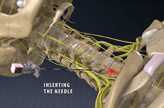 Stellate Ganglion Block In Knoxville Omega Pain Management