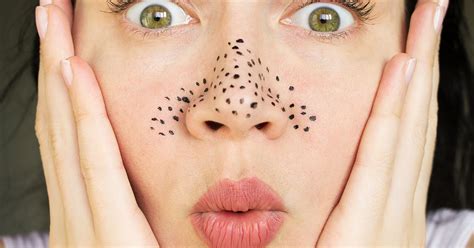 Sebaceous Filaments What Are They And How Do You Get Rid Of Them