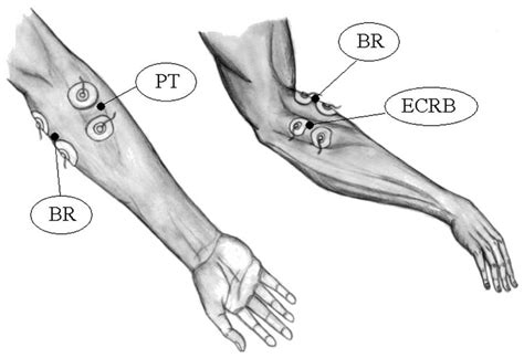 Electrode Placement Wrist Extensors At Gina Stach Blog