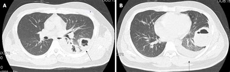 Pleural Effusion In An Immunocompetent Host With Cryptococcal Pneumonia