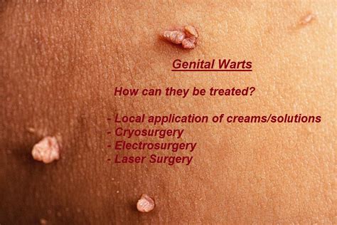 How Are Genital Warts Treated Aries Obgyn Clinic