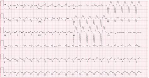 Electrocardiogram Showing Ventricular Paced Rhythm Download
