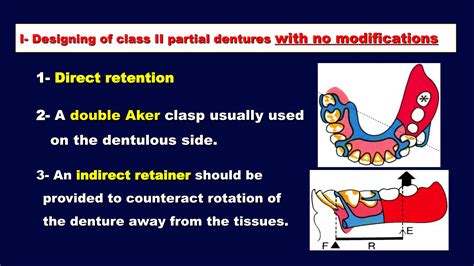 2 B Basic Principles For Designing Kennedy Class Ii Iii And Iv Rpd