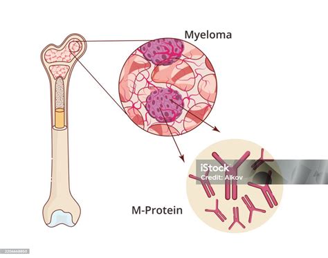 Myeloma Pathology Illustration Illustration Of A Bone Marrow With