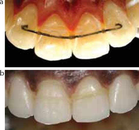 Orthodontic Update Bonded Orthodontic Retainers