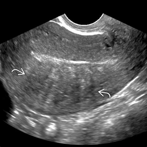 Adenomyosis Radiology Key