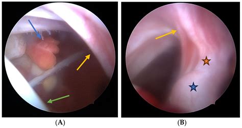 Arthroscopic Excision Of Scapular Exostoses A Technical Note