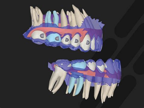 Fas Aligner Forestadent