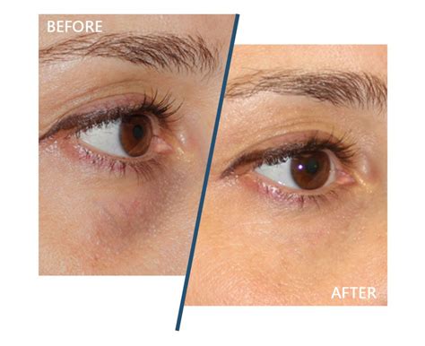 Sunken Eyes Pictures Before And After