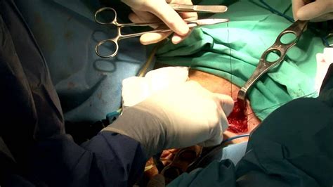 Artificial Urinary Sphincter Implant Youtube