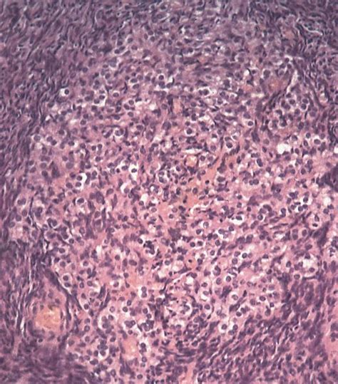 Pathology Outlines Stromal Hyperplasia And Hyperthecosis