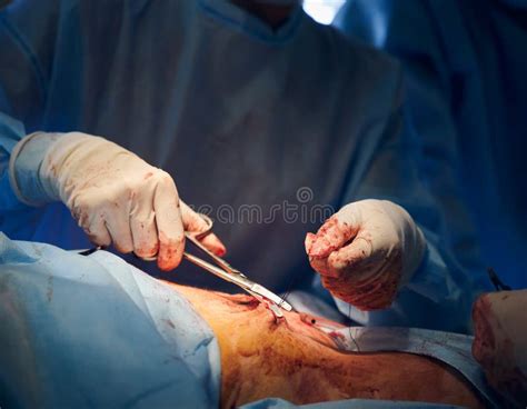 Doctor Stitching Up Wound After Abdominoplasty Surgery Stock Image