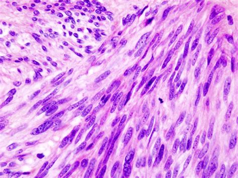 30 Facts About Kaposi Sarcoma Soft Tissue Sarcoma