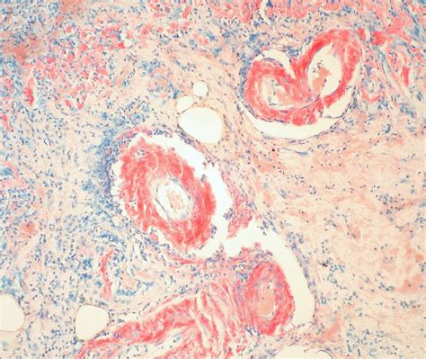 Gastric Amyloidosis Congo Red Stain Ed Uthman Flickr