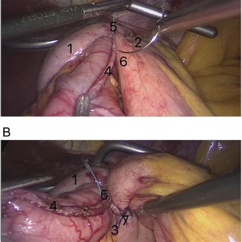 After Circularly Fundoplication We Created Partial Fundoplication With