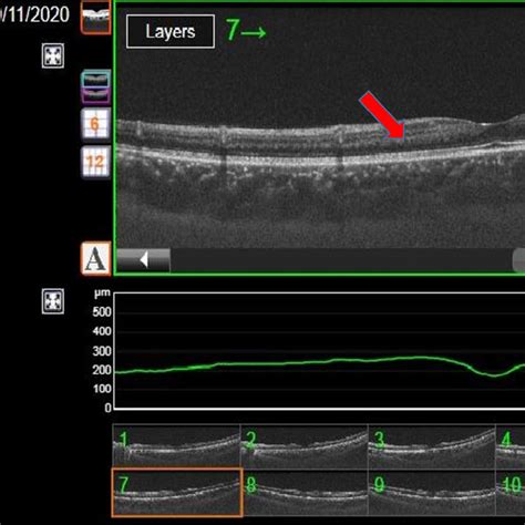 Oct Vertical Sections Display Thickening And Hyperreflectivity In The Download Scientific