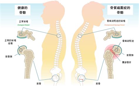 骨骼健康 Bone Health — Aamg Doctors 美亞醫療集團