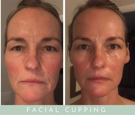 Online Training The Facial Cupping Expert